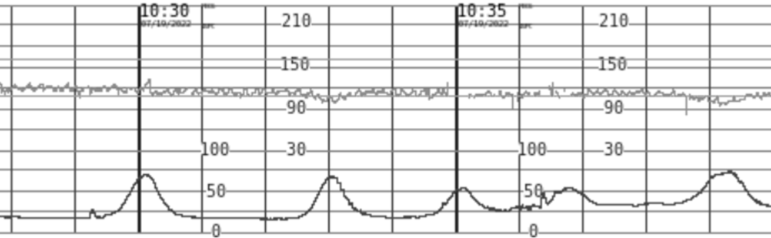 80_EHR_Tracings | OBIX P.O.E.T.